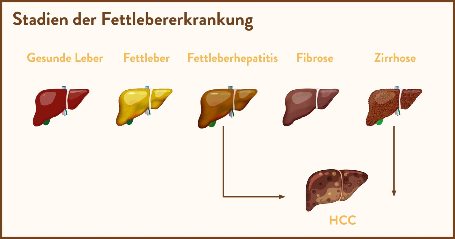 Lebergesundheit und Ernährung: Tipps für eine gesunde Leber ...
