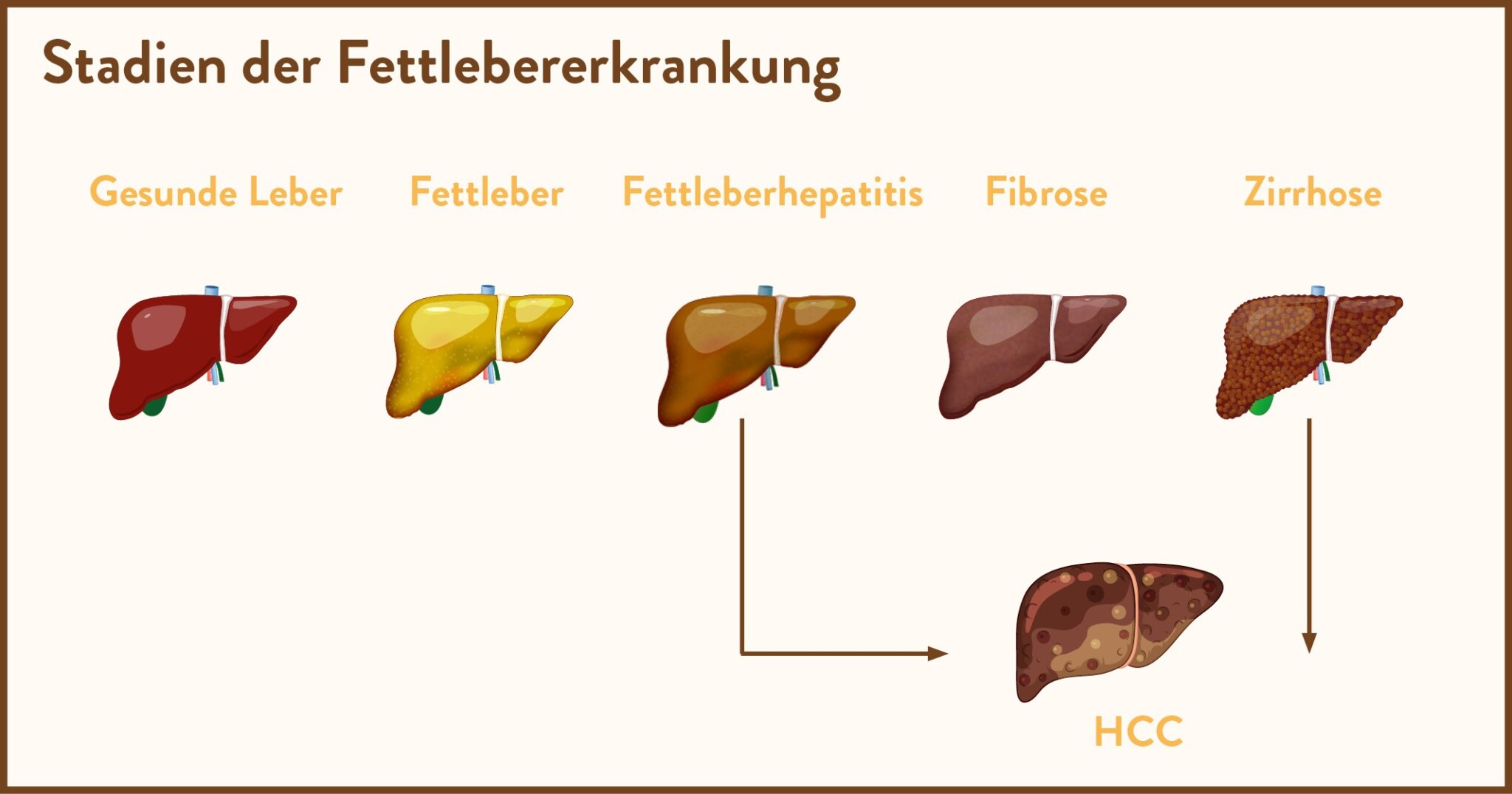 Alkoholische Fettleber (AFLD): Ursachen, Symptome, Prävention ...